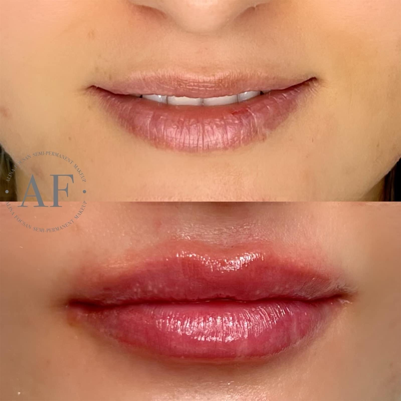 Lip Filler | Treatments/Services