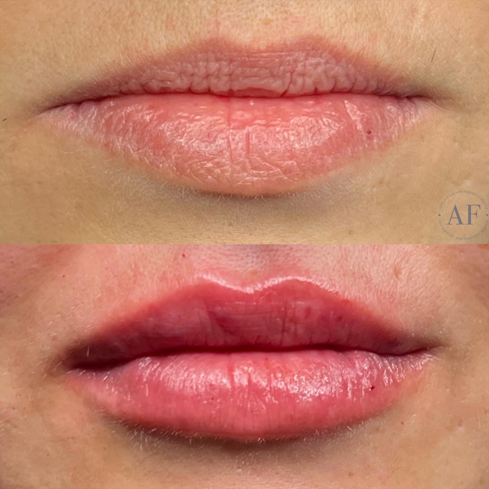 Lip Filler | Treatments/Services